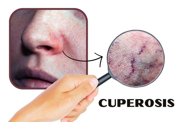 Tratamiento para la Cuperosis ¿Qué es y Cómo Eliminarla?